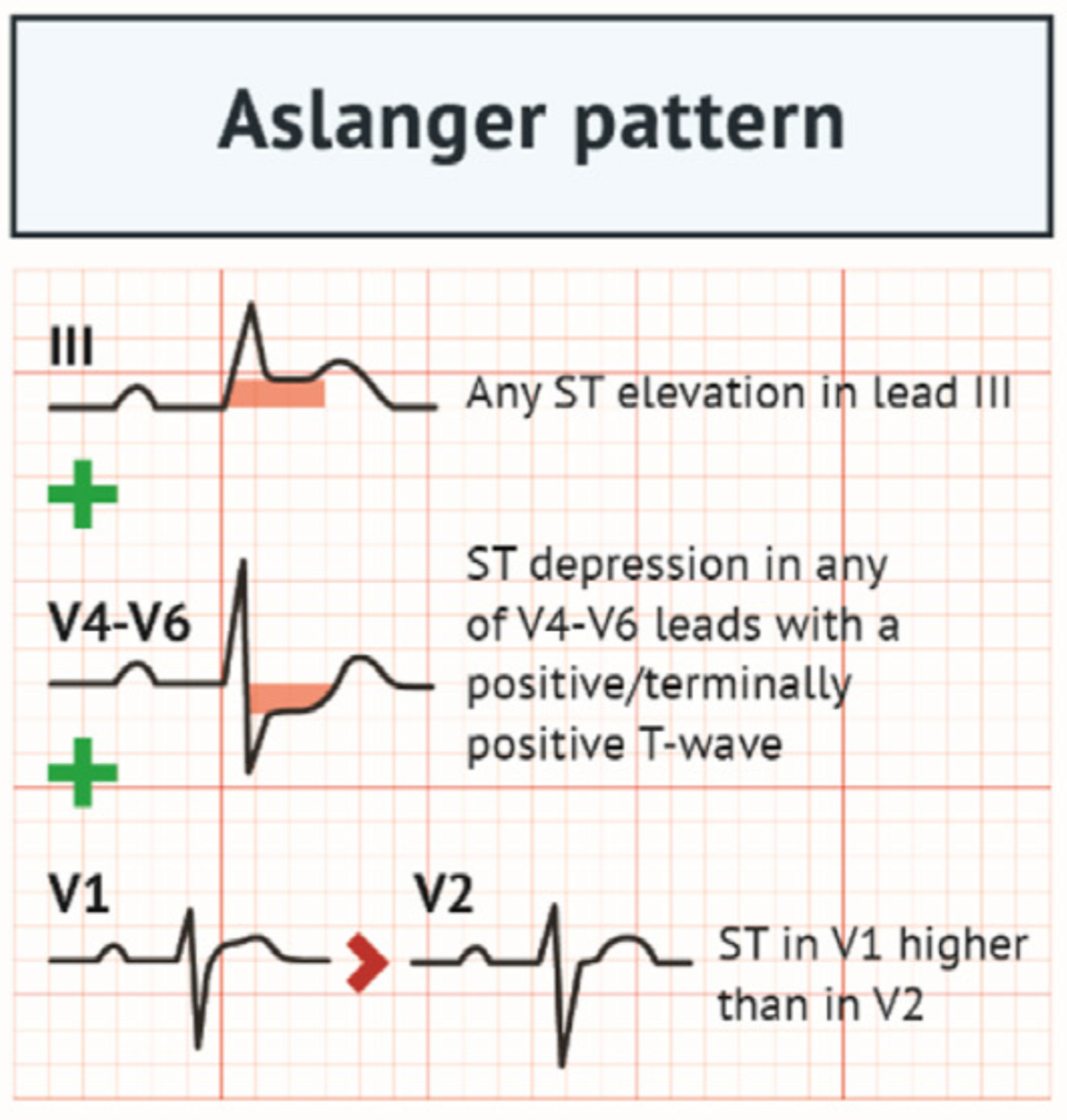 Reconocimiento de Patrones ECG Atípicos que obligan activación de ...